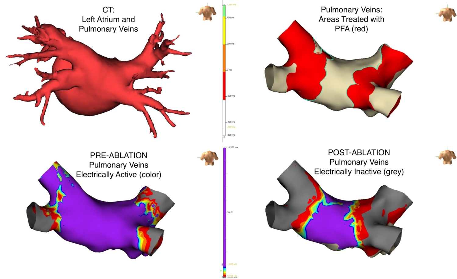 PFA pulsed field ablation in Minneapolis MN - Metropolitan Heart ...